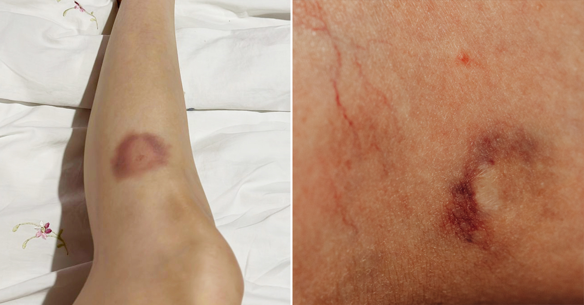 How Do I Get These Mysterious Bruises When I Don’t Bump Into Anything?