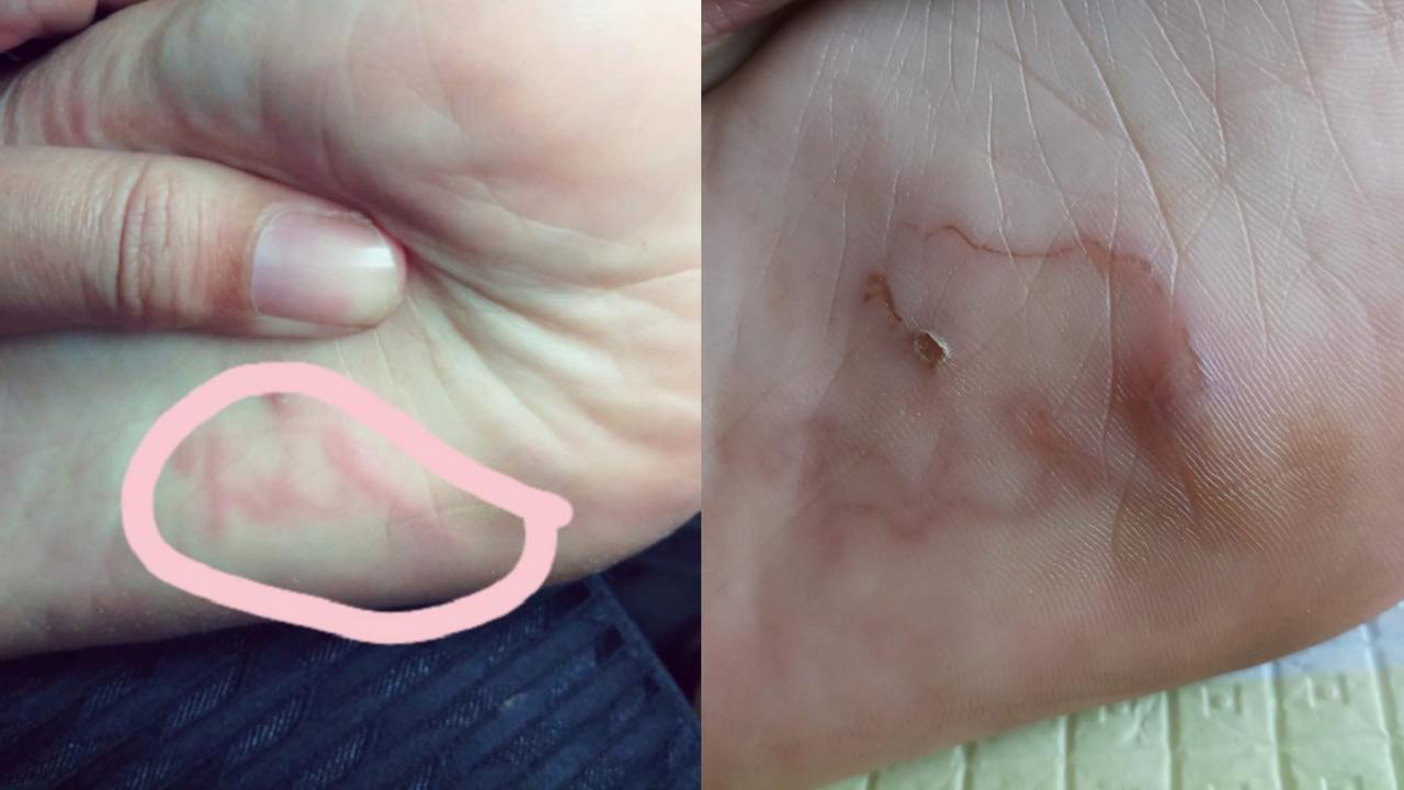 Woman Discovers A Worm In Her Foot After Not Wearing Shoes On A Port ...