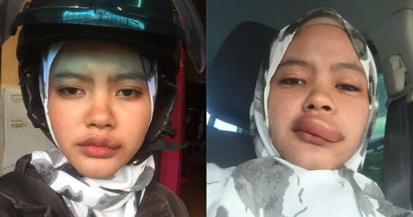 Woman Gets Stung By An Insect And People Can’t Stop Giggling At Her Photos