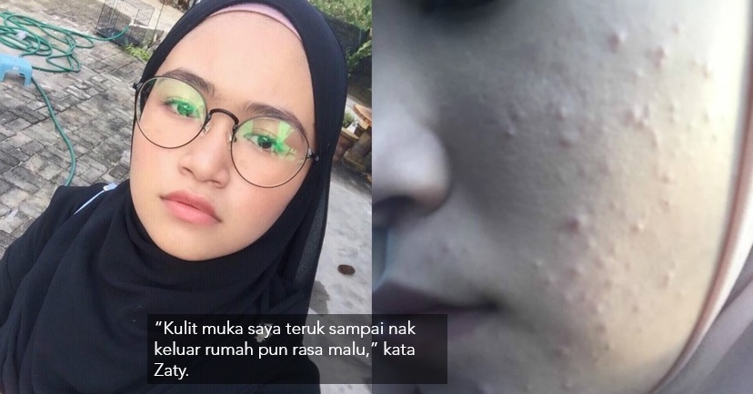 ‘Kulit Muka Saya Bertambah Teruk Selepas Berhenti Gunakan Produk Tempatan’