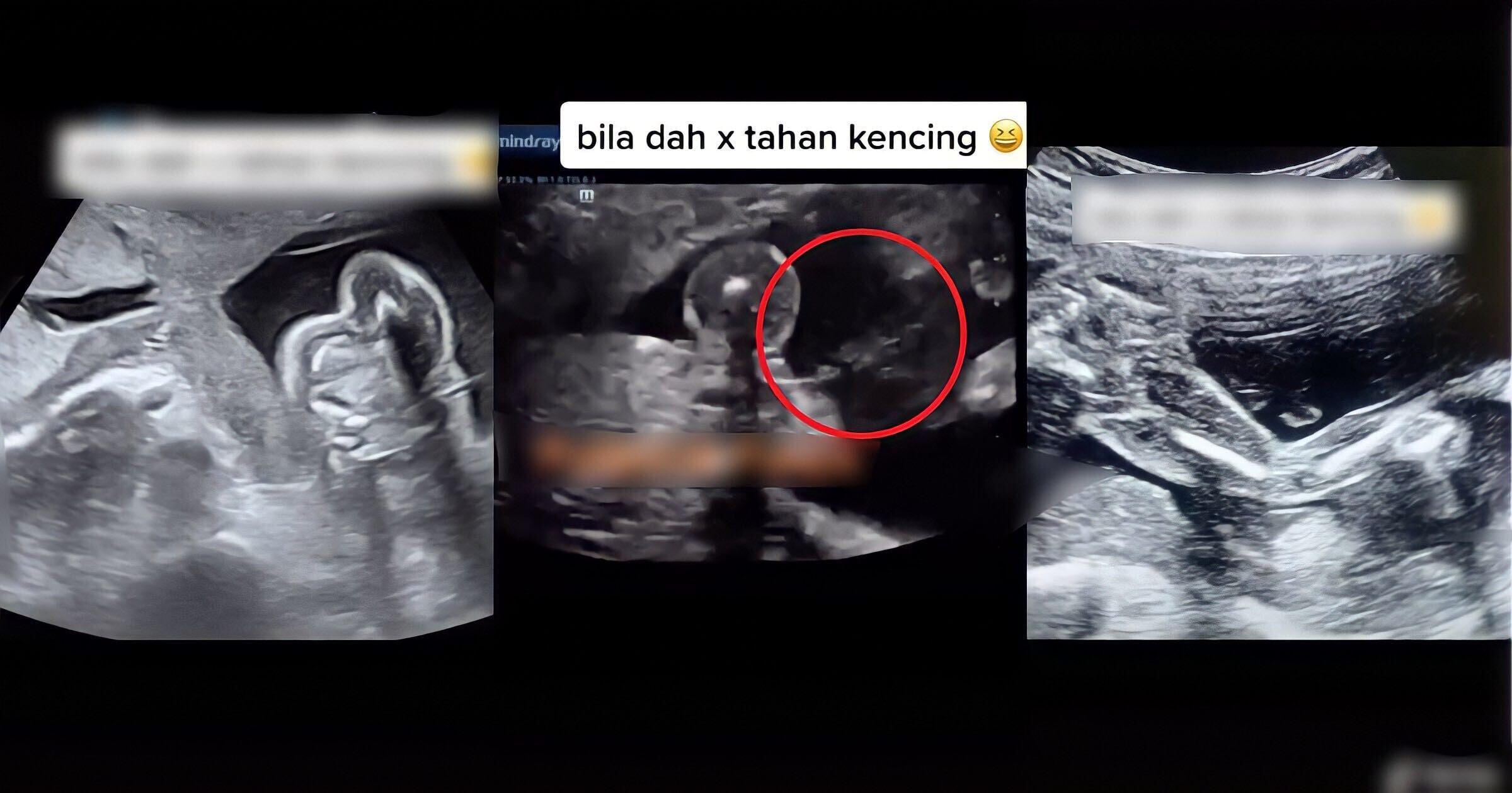 Klinik Ini Kongsi Kompilasi Video Baby Kencing Dalam Perut Ibu, Ramai ...