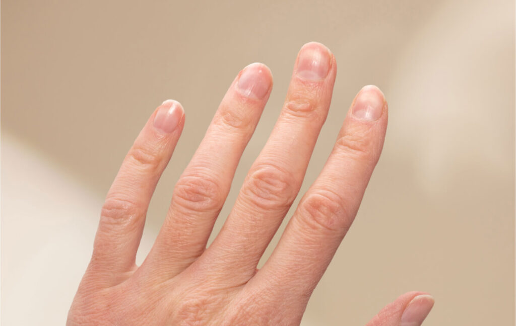 Did You Know Your Nails Could Indicate Health Issues? Here Are 5 ...