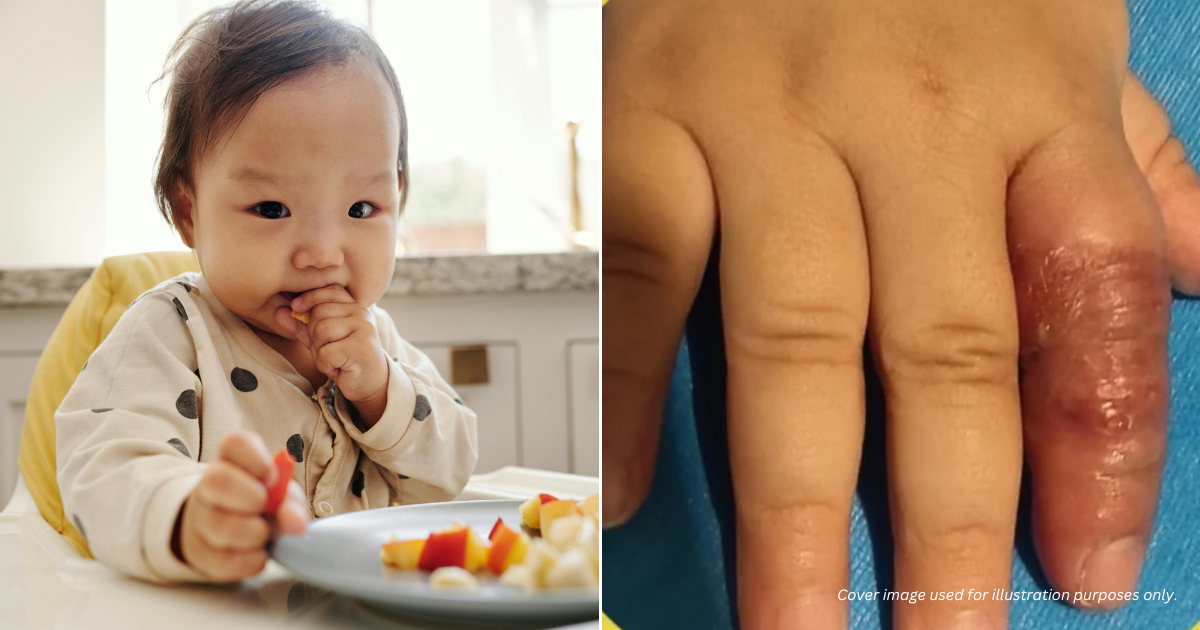 Mum Wraps Baby’s Finger To Stop Biting Habit, Nearly Causes Amputation