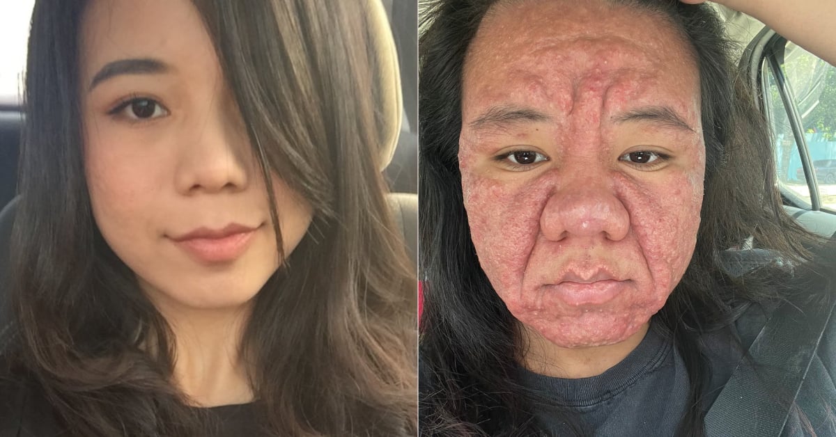 Malaysian Woman Opens Up About Battling Severe Hormonal Acne During ...
