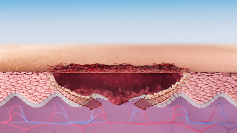 “Put Plaster Or Not?” — Why Letting A Wound Heal On Its Own May Not Be ...