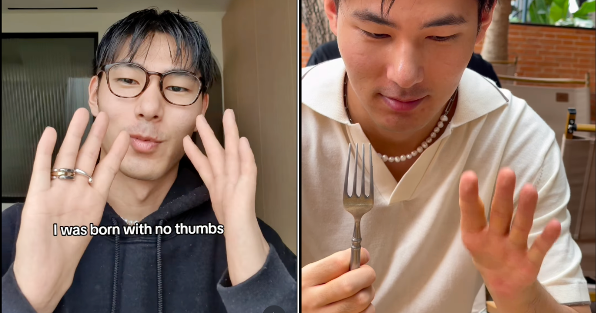 Man Born Without Thumbs Jokes He Can Escape Handcuffs & Get Cheaper ...