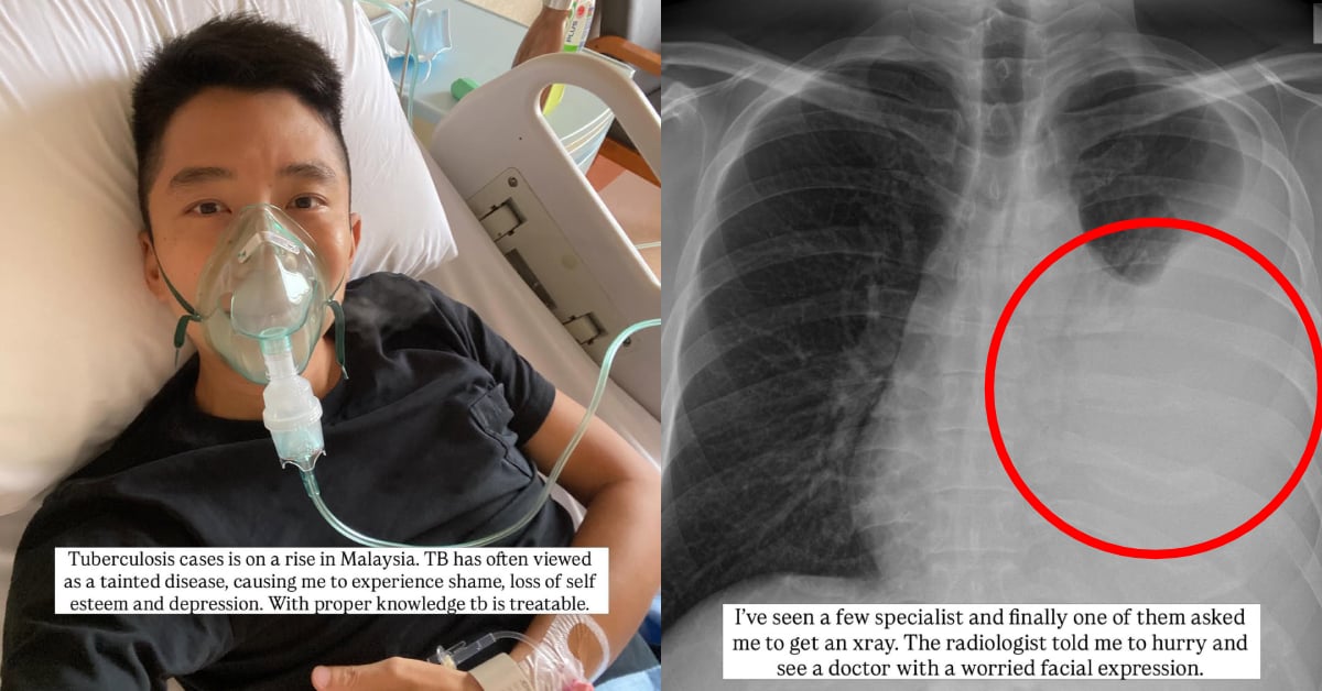 Malaysian Shares Struggle Of Battling TB Twice While Completing 3 ...